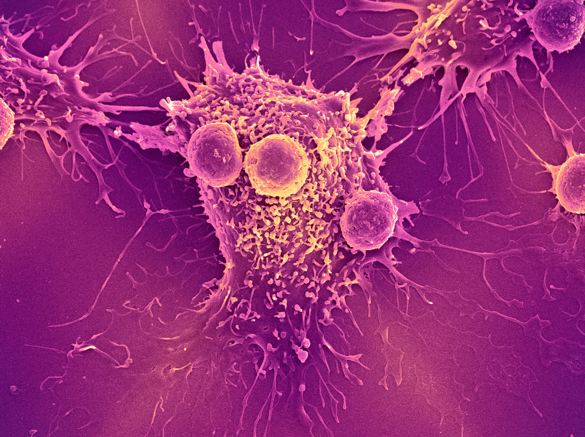 Tumor-Infiltrating Lymphocytes | Eureka blog